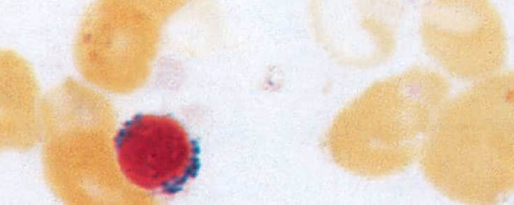 Anemias microcíticas e macrocíticas