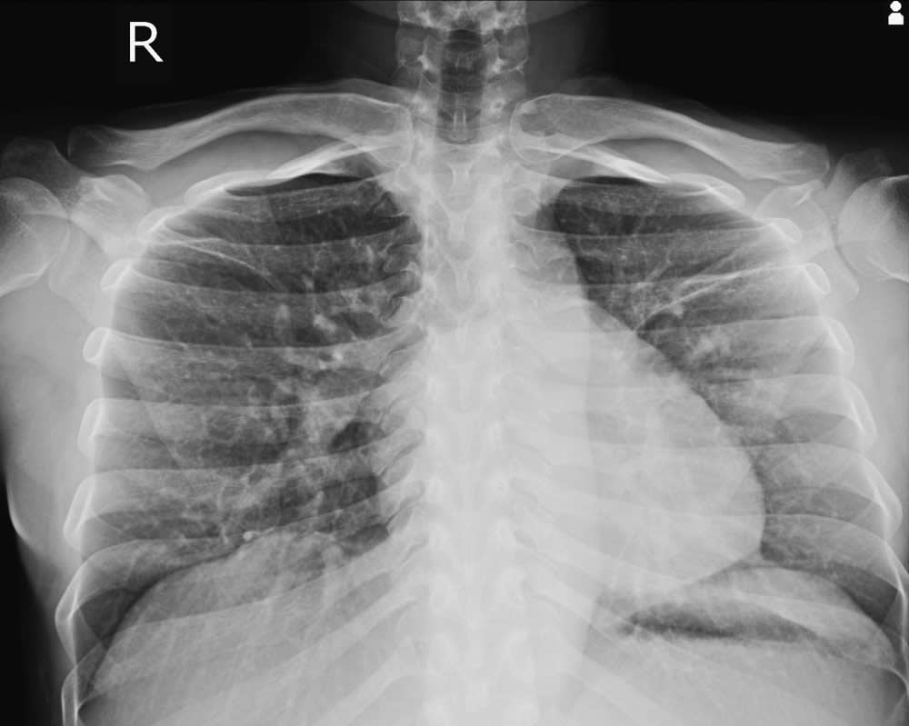 ANATOMIA RADIOLÓGICA DO TÓRAX