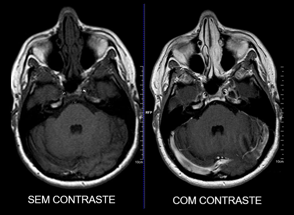 Formação da Imagem em Ressonância Magnética